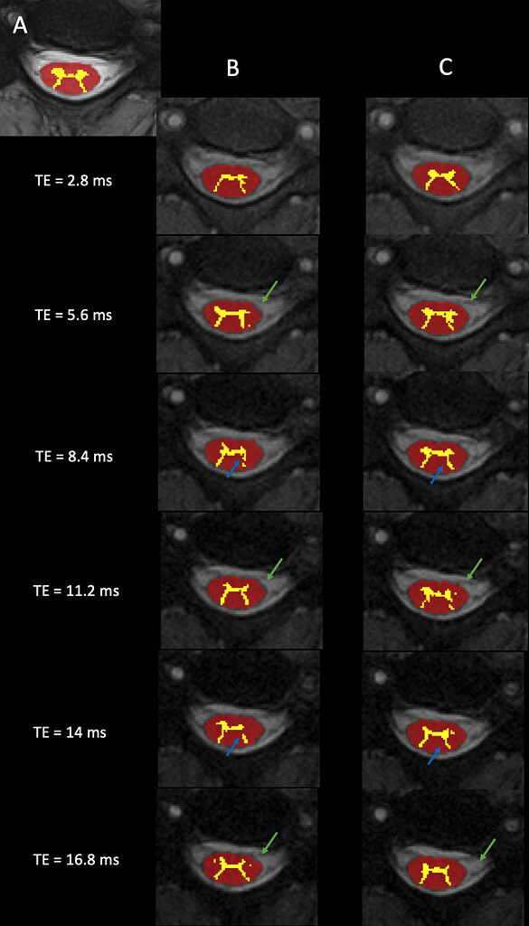 The case for frequency navigators - MRI Acquisition - Spinalcordmri.org
