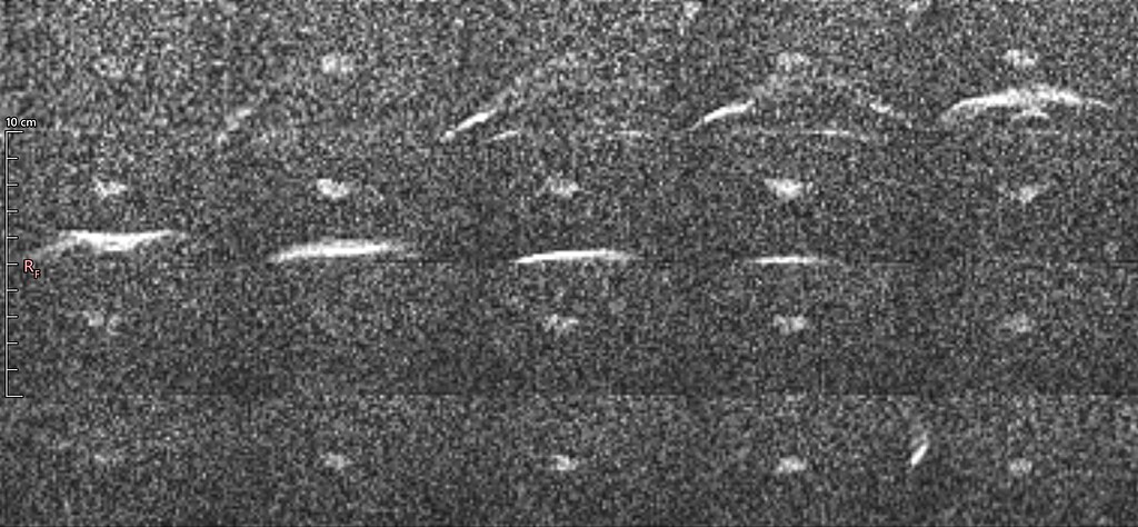 Question about DWI artifacts - MRI Acquisition - Spinalcordmri.org